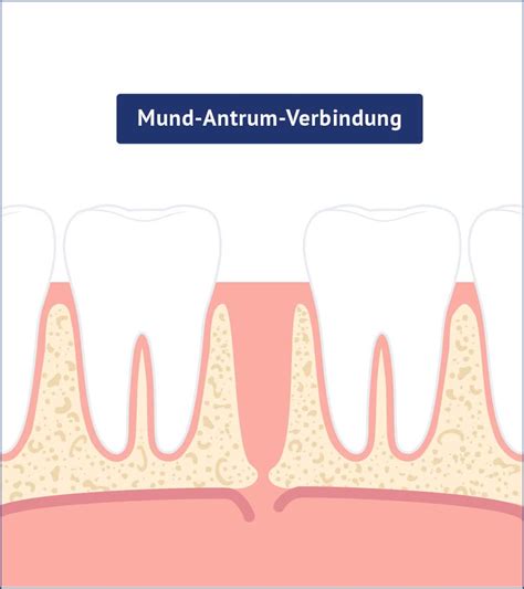 Mund Antrum Verbindung Behandlung Mkg Wuppertal