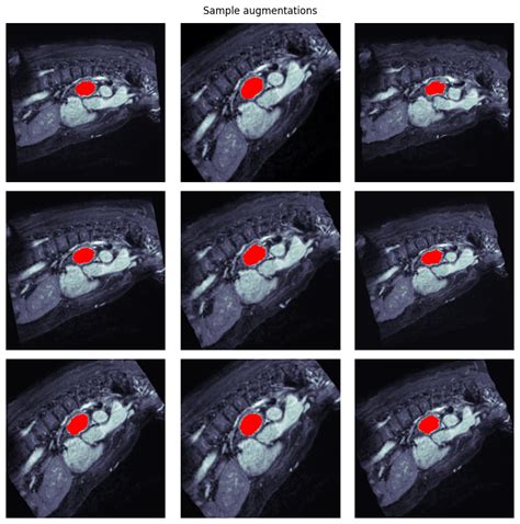 Atrium Segmentation Syedfaizaan