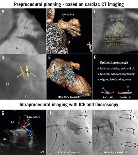 Percutaneous Left Atrial Appendage Closure In A Surgically Ligated Left