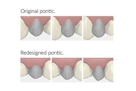 Invisalign G6 Invisalign Discover New Possibilities