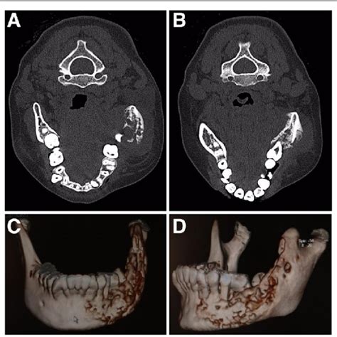 Pdf Mycobacterium Tuberculosis As A Cause Of Mandibular Osteomyelitis In A Young Woman A Case