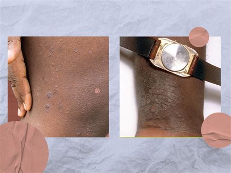 What Is The Difference Between Atopic And Contact Dermatitis