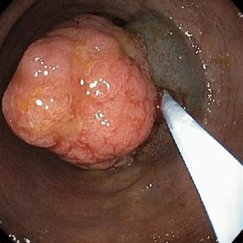 Endoscopic Image The Same Polyp As In Fig 1 Submucosal Injection Of