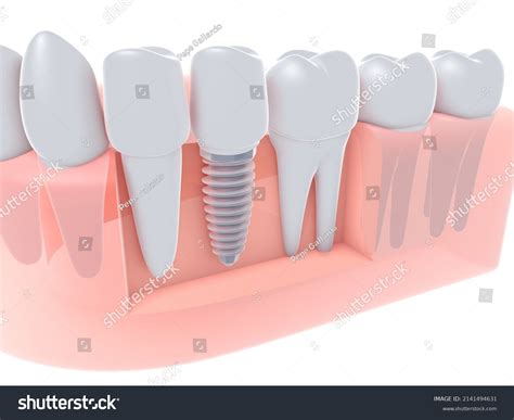 잇몸에 삽입되는 치과 임플란트의 3d 그림 스톡 일러스트 2141494631 Shutterstock