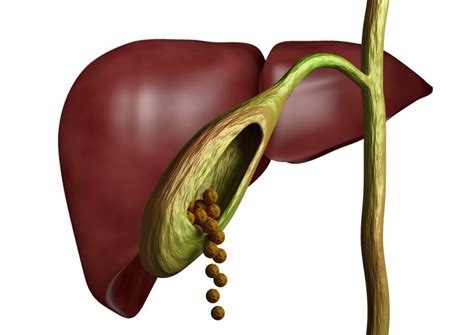 Gallstones And Common Bile Duct Stones Gastro Care