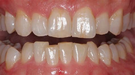 Smile Gallery Krause Comprehensive Dental Care