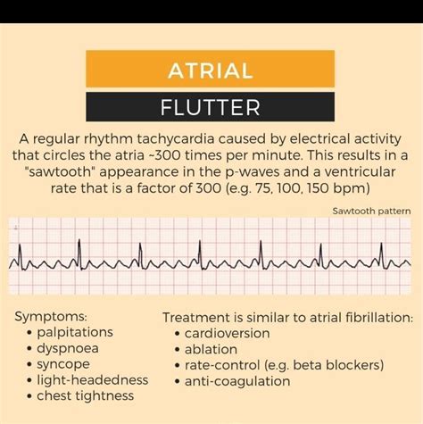 Atrial Flutter Artofit