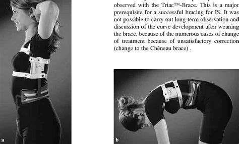 Figure 1 From The Flexible Triac Brace For Conservative Treatment Of Idiopathic Scoliosis An