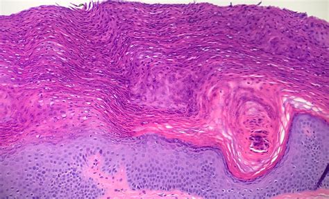 Granular Parakeratosis Histology Darier Disease
