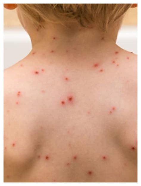 చికెన్ పాక్స్ రాకుండా ఉండాలంటే ఏం చేయాలి Natural Ways To Prevent Chickenpox Spread And