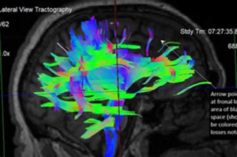 Dti Diffusion Tensor Imaging Lifesciences Imaging
