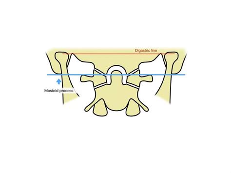 Ct Cervical Spine Pptx