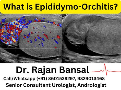 What Is Epididymo Orchitis