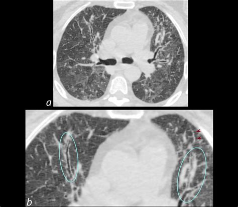 Faces Of Rheumatoid Arthritis And The Lung The Common Vein
