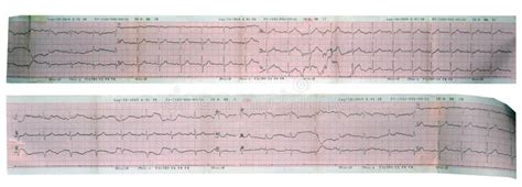 Echocardiogram Reading Axis View Ecg Ekg Stock Image Image Of