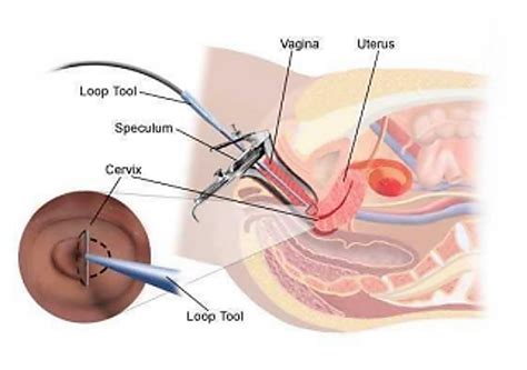 Understanding The Large Loop Excision Of The Transformation Zone Lletz