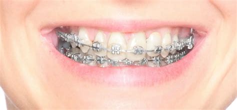 Cavities Caused By Braces 6 Useful Oral Hygiene Steps