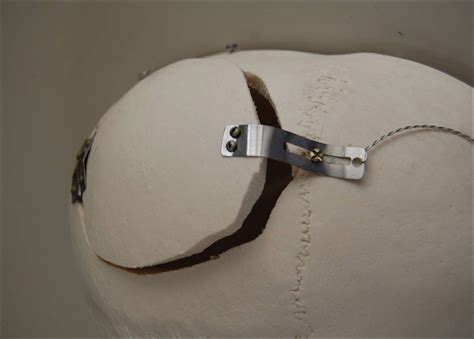 The “skull Flap” A New Conceived Device For Decompressive Craniectomy