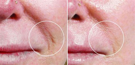 Juvpen Get Incredible Results With Minimal Downtime