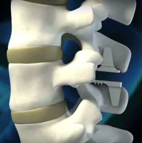 Best Spinal Stabilization Exercises Without The Use Of Weights Or