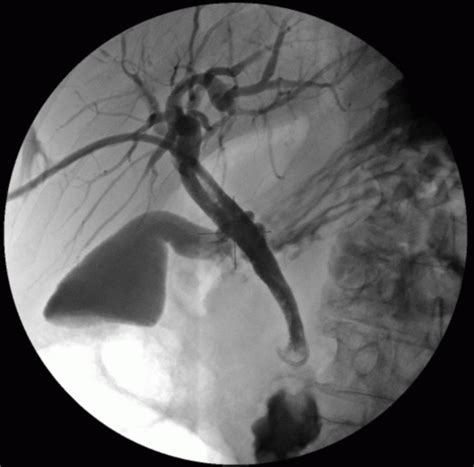 Percutaneous Transhepatic Cholangiography Ptc Doccheck