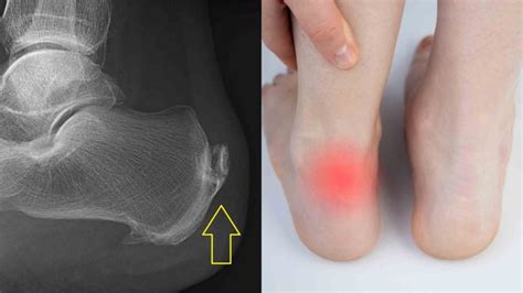 What Causes Achilles Tendon Calcification Its Symptoms Physiotherapy