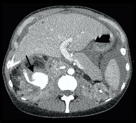 Abdominal Computed Tomography Ct Scan An Arterial Blush Is Shown