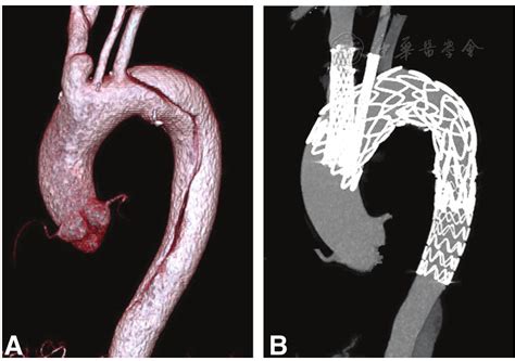 Endovascular Management Of Aortic Arch Diseases Current Status And