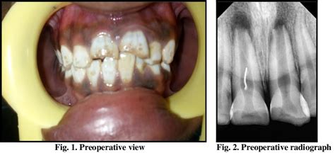 Figure 1 From Management Of Open Apex Using Mta And Reinforcement Of Weekend Root With