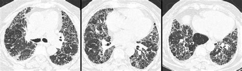 Chronic Hypersensitivity Pneumonitis With Usual Interstitial Pneumonia