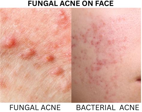 Fungal Acne Pictures A Doctors Guide To Spot On Face Body