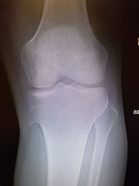 Osteochondroma Projecting Medially From The Proximal Tibial Metaphysis Rradiology