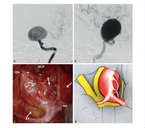 Paraclinoid Aneurysm Of The Transitional Type A Cag Direct Download Scientific Diagram