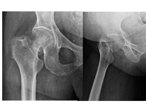 Nof Fixation Sequence Ppt