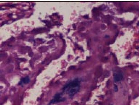 Aceot Histologic Examination Reveals Sheets Of Polyhedral Epithelial