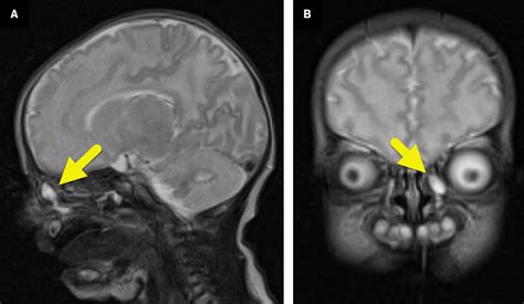 Nasolacrimal Duct Mucocele Applied Radiology