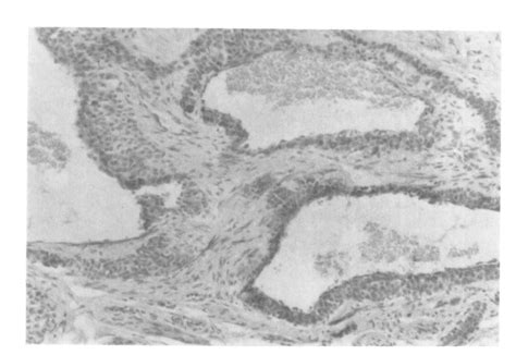Microcystic Type Of Glomus Tumor All Glomus Cells Dark Stained With