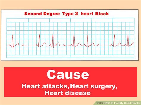 Different Types Of Heart Blocks Explained At Cynthia Brandenburg Blog
