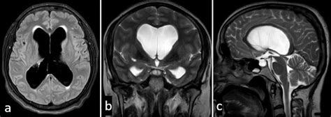 Endoscopic Management Of Idiopathic Foramen Of Monro Stenosis Journal