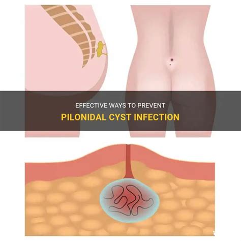 Effective Ways To Prevent Pilonidal Cyst Infection Medshun