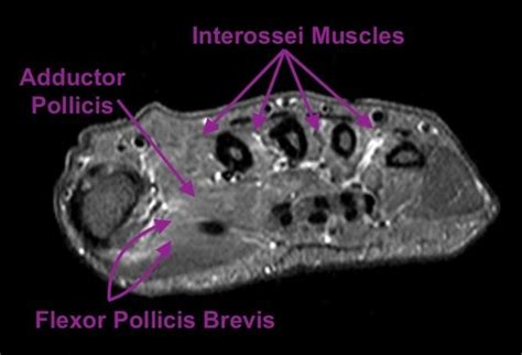 Florence Le Guyons Canal Surgery