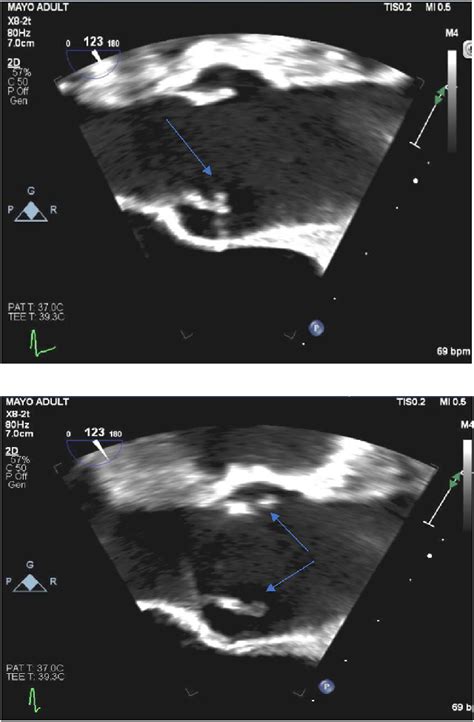 Mid Esophageal Transesophageal Echogram Tee Of Left Ventricular