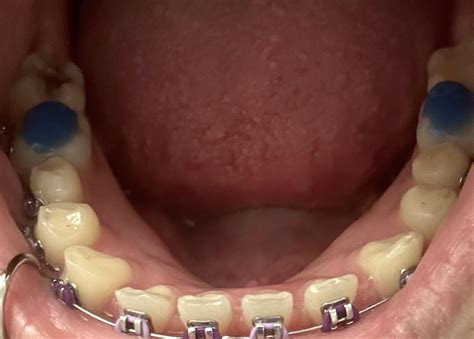 I Hate These Bite Blocks😭 R Braces
