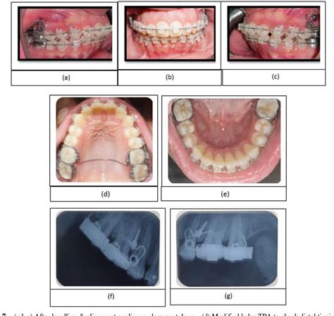 Figure 7 From Molar Distalization Using Orthodontic Implants A Review