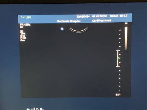 Philips C8 5 Broadband Curved Array Ultrasound Transducer Probe Auschoice