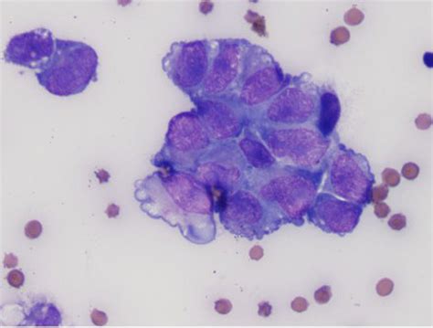 Mesenchymal Tumors Eclinpath