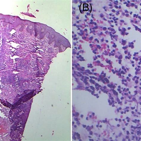 Histopathology Shows Psoriasiform Spongiotic Hyperplasia With Download Scientific Diagram