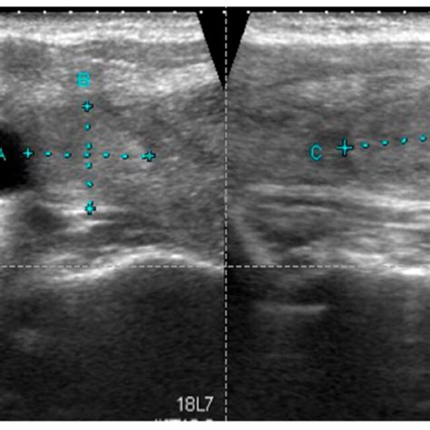 Typical Sonographic Pattern Of A Brafv600e Positive Papillary Thyroid