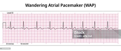 Ecg Wandering Atrial Pacemaker 8 Second Ecg Paper Stock Illustration Download Image Now Istock