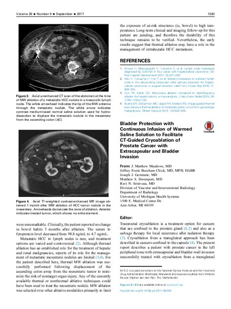 Pdf Bladder Protection With Continuous Infusion Of Warmed Saline Solution To Facilitate Ct